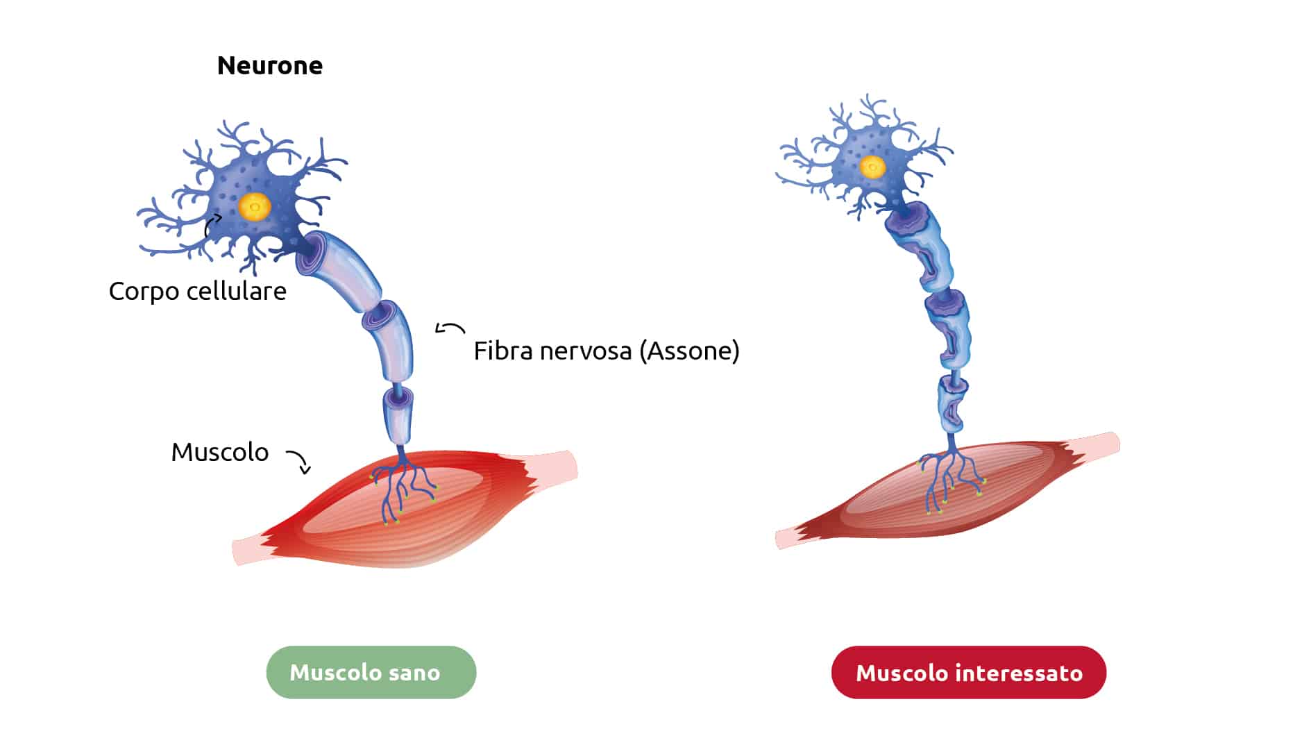 Malattia SLA - Cos'è e come si manifesta? - Otolift